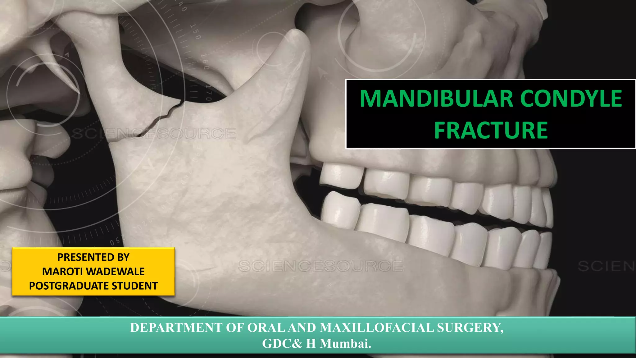 Management of Mandibular Condyle fracture | PPTX