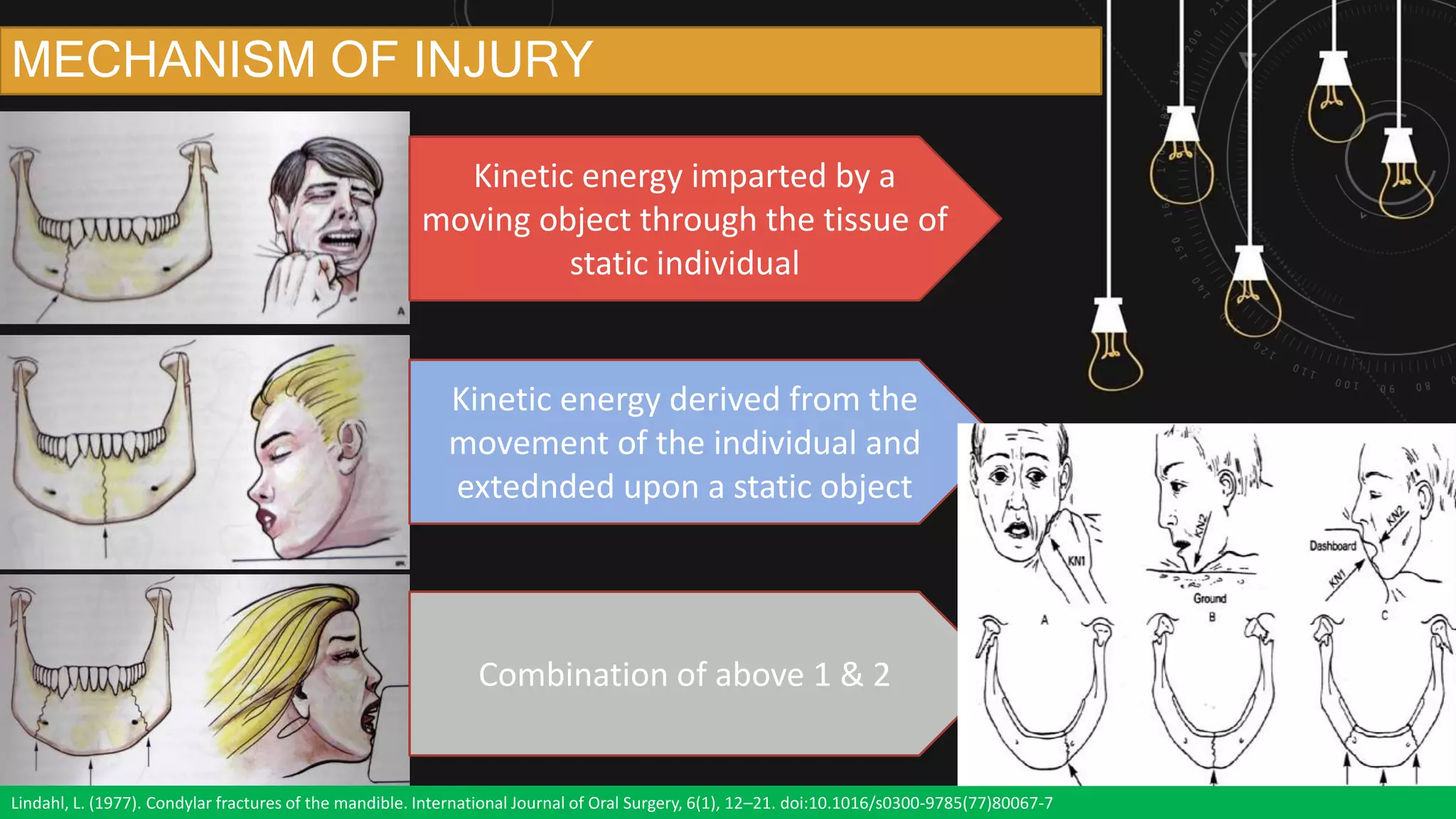 Management of Mandibular Condyle fracture | PPTX