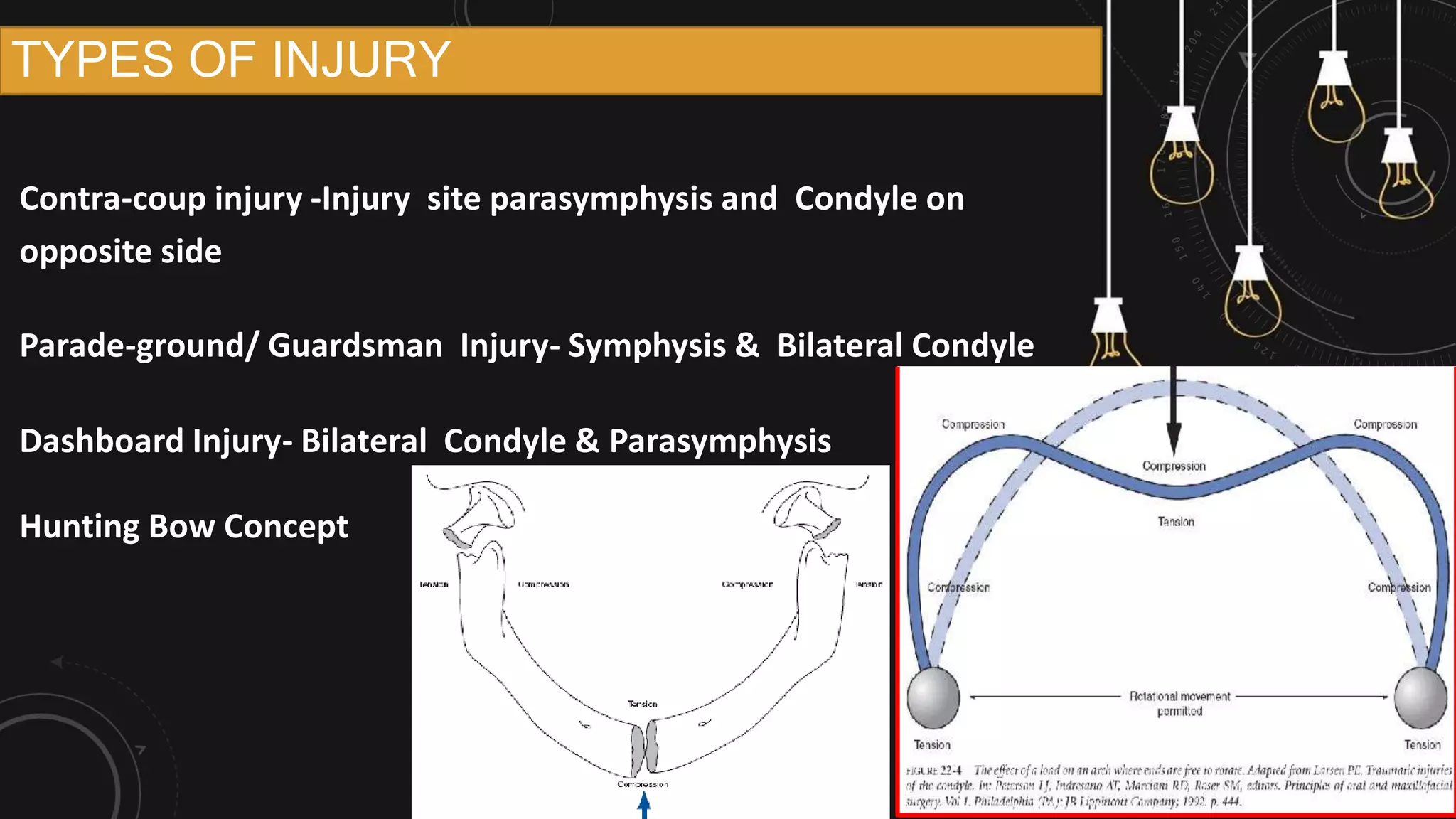 Management of Mandibular Condyle fracture | PPTX