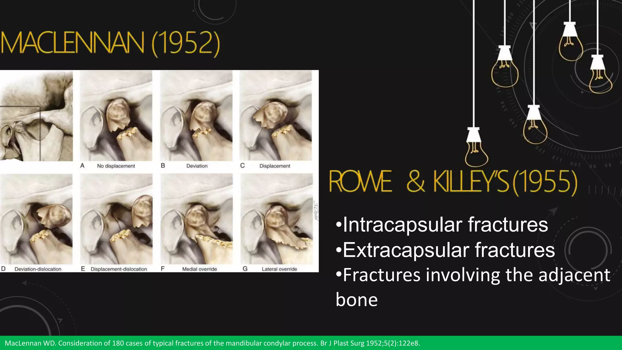 Management of Mandibular Condyle fracture | PPTX