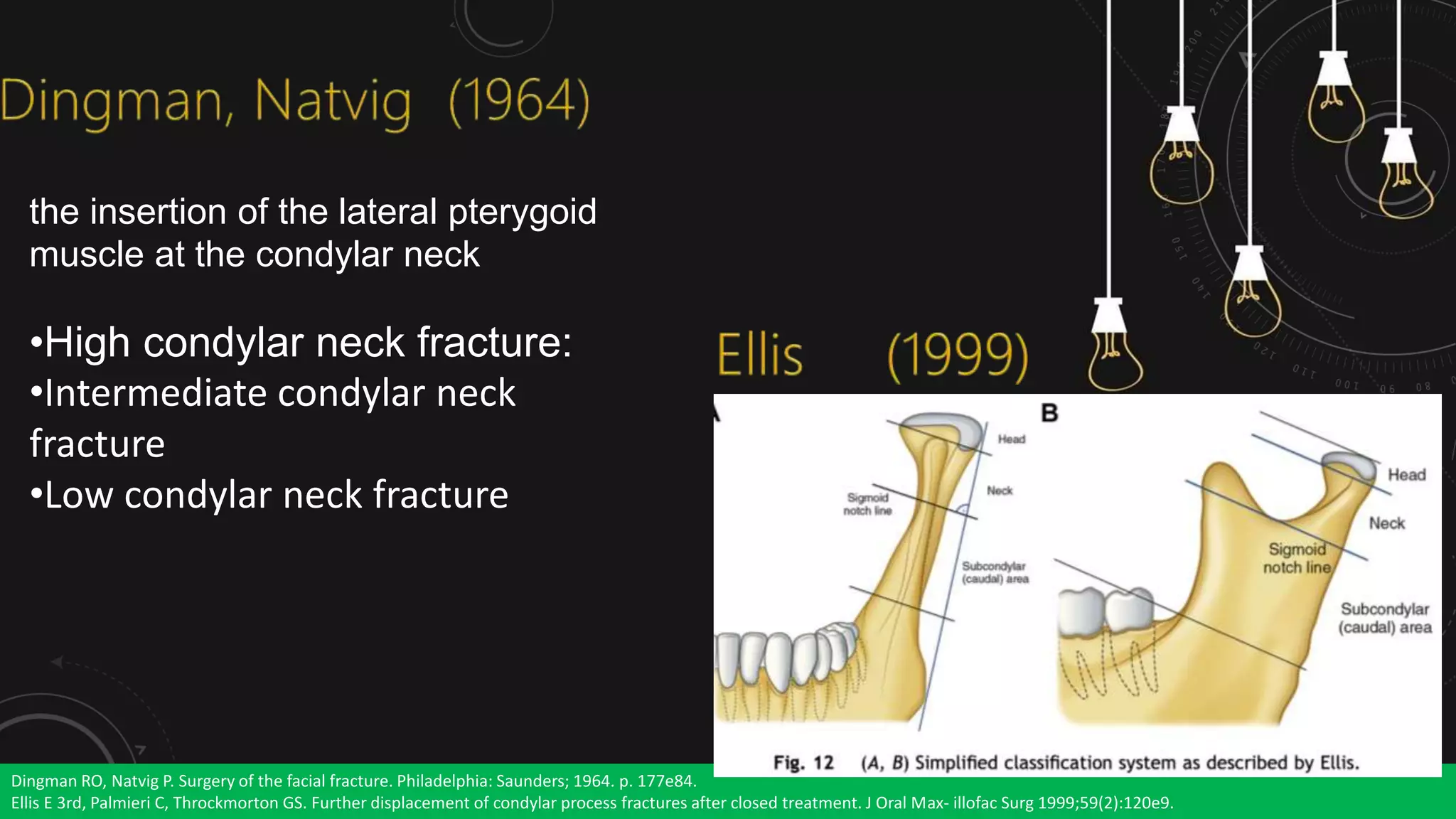Management of Mandibular Condyle fracture | PPTX