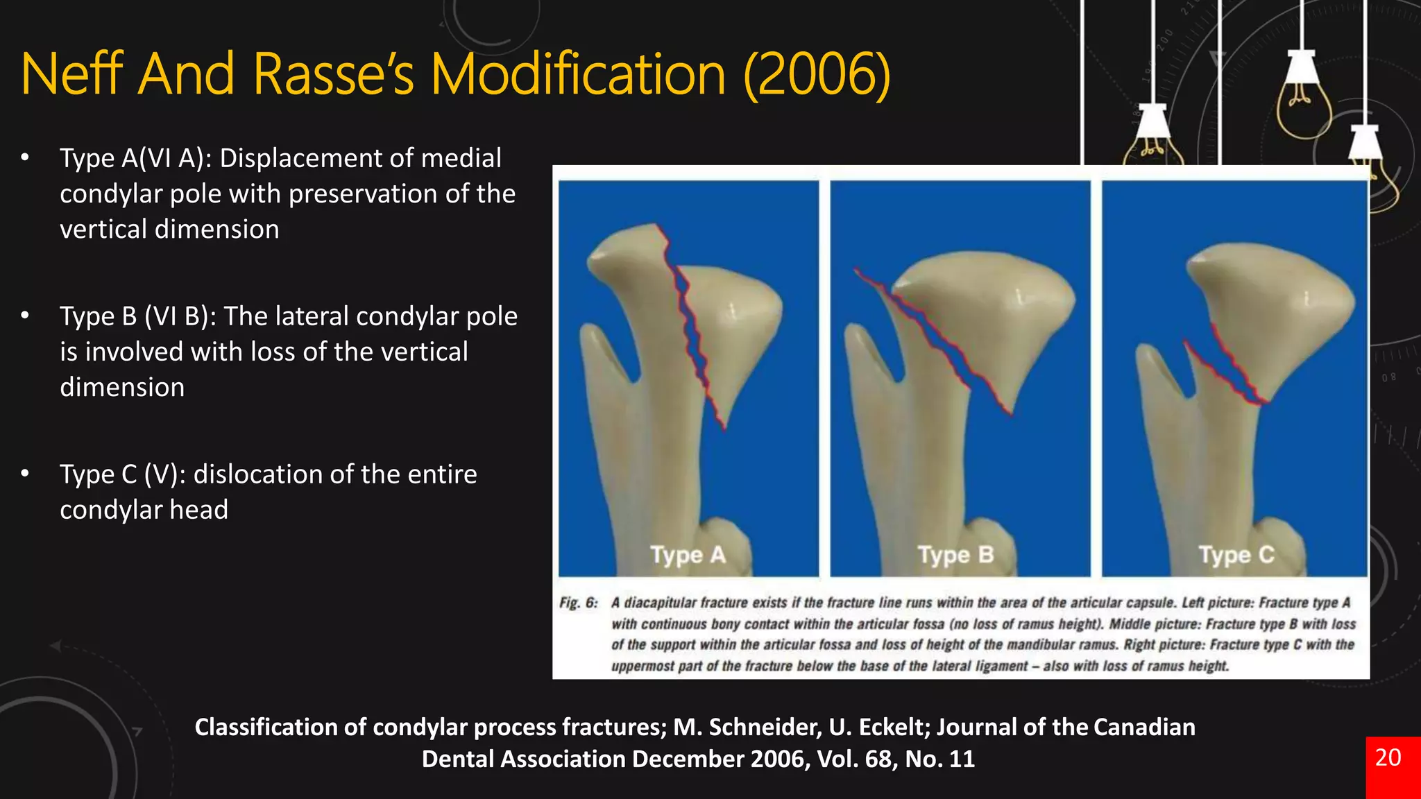 Management of Mandibular Condyle fracture | PPTX