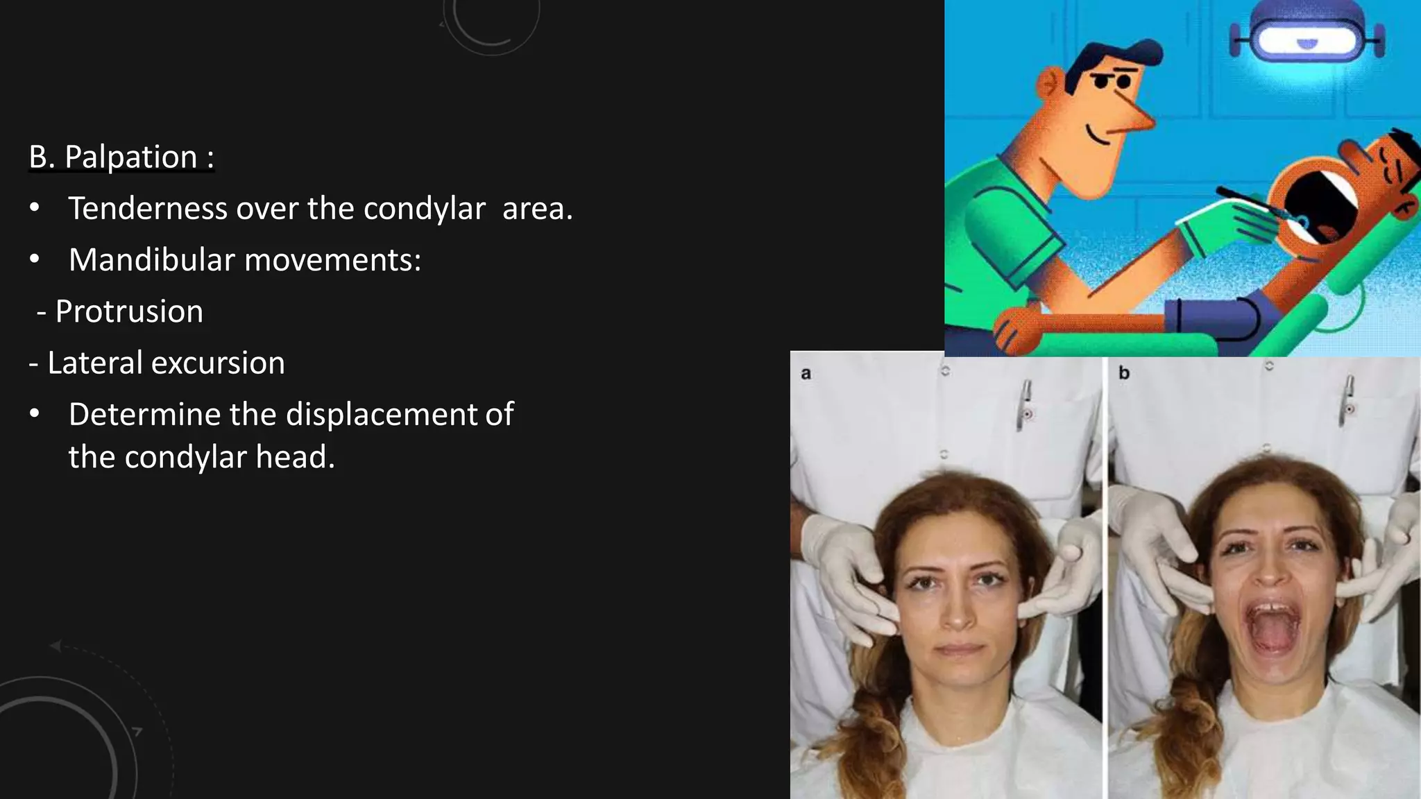 Management of Mandibular Condyle fracture | PPTX
