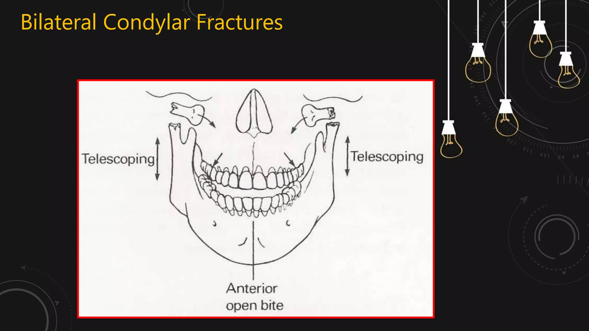 Management of Mandibular Condyle fracture | PPTX