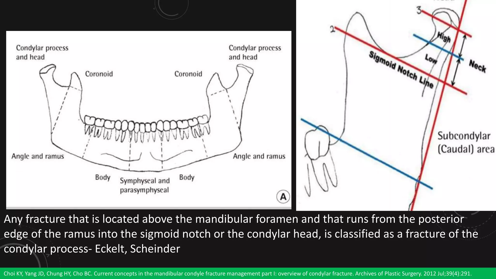 Management of Mandibular Condyle fracture | PPTX