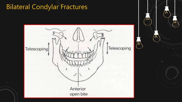 Management of Mandibular Condyle fracture | PPTX | Death, Injury, or ...