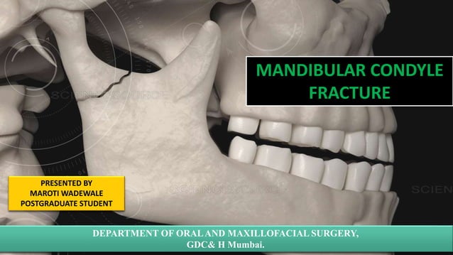 Management of Mandibular Condyle fracture | PPT