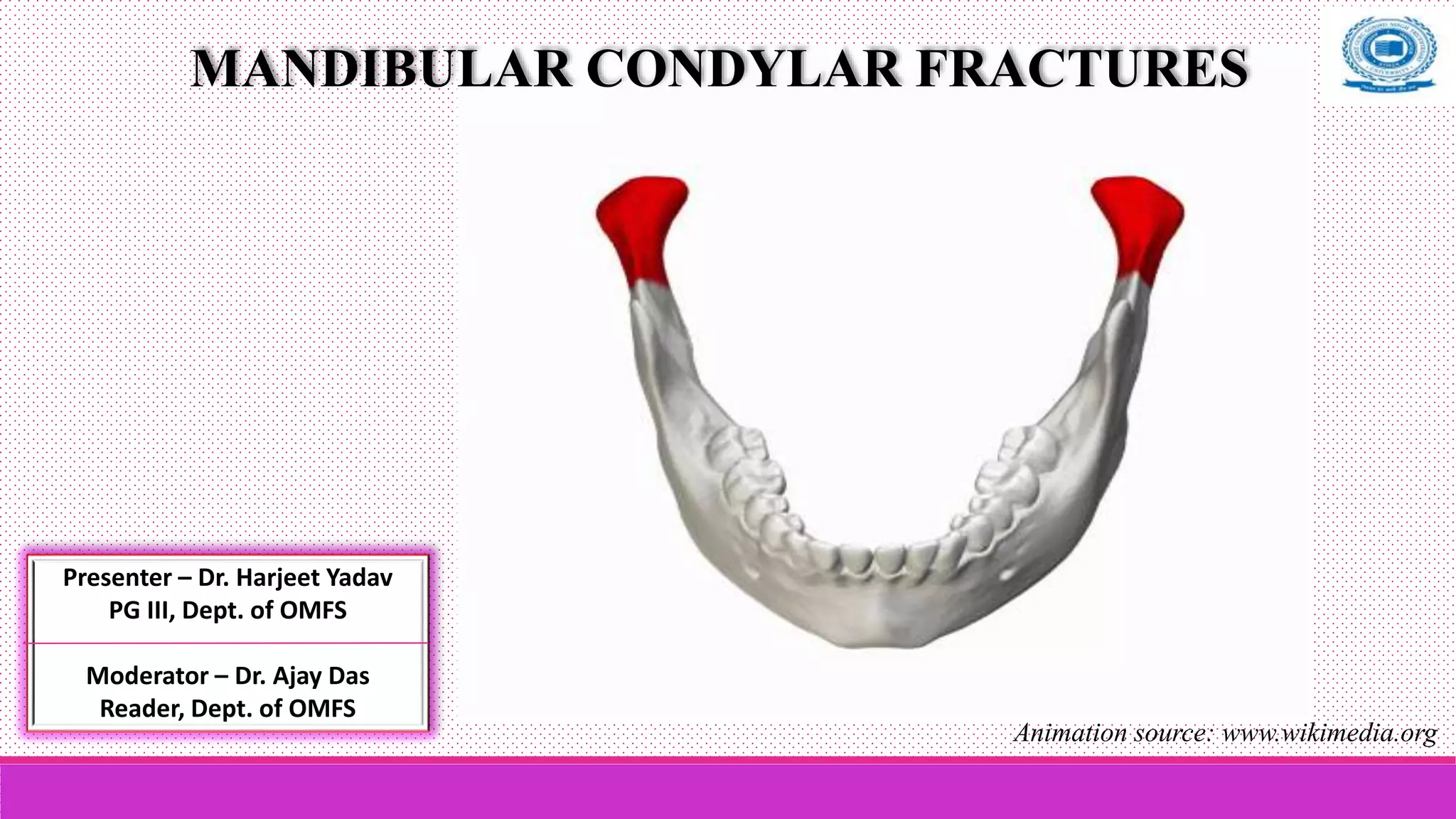 Condyle Fractures.pptx