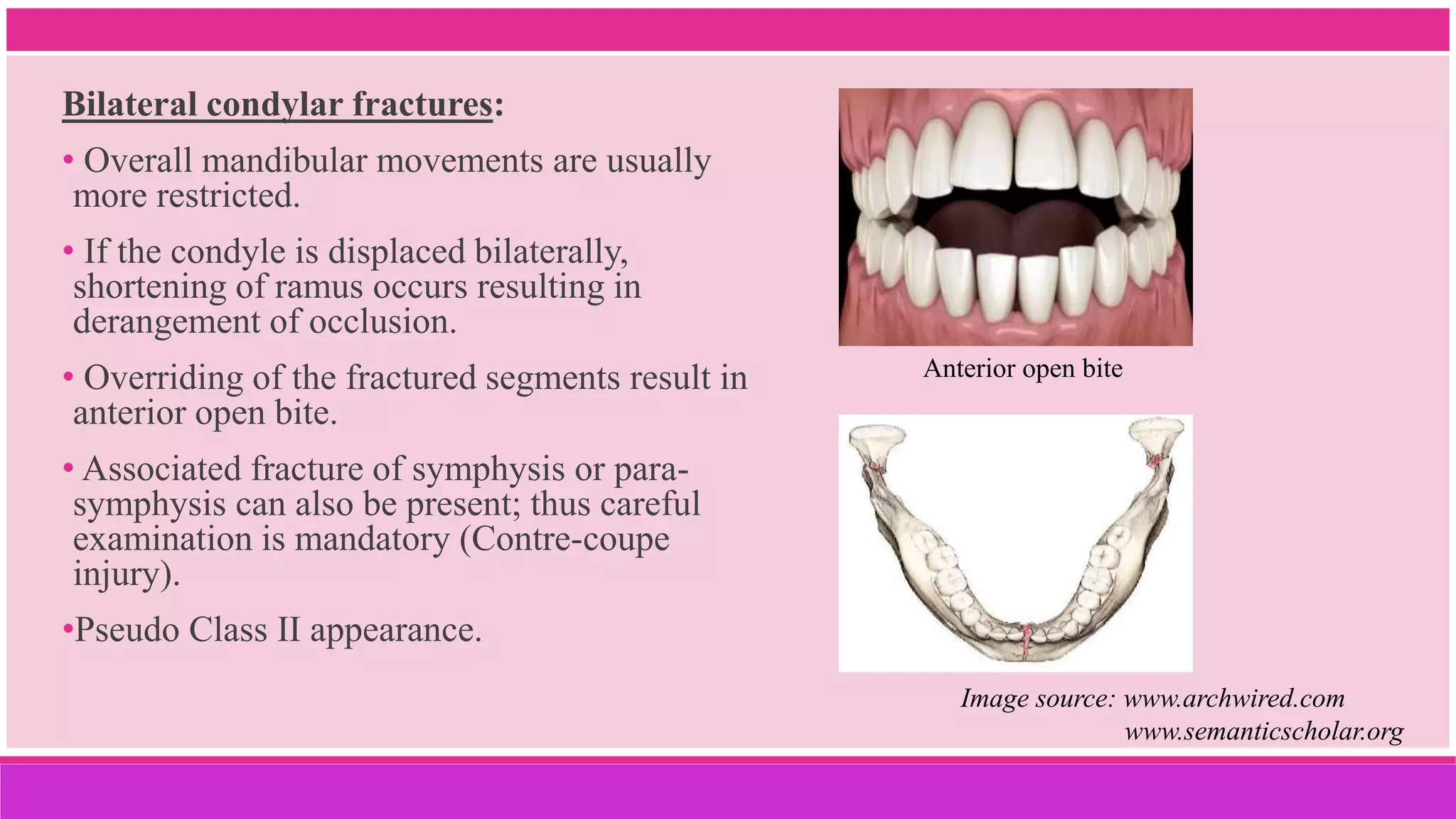 Condyle Fractures.pptx