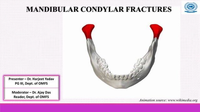 Condyle Fractures.pptx