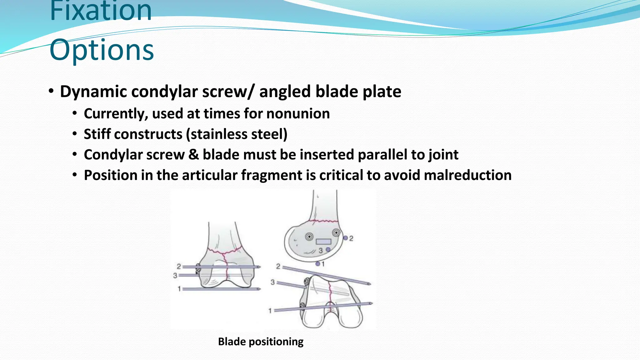 Condyles of Femur Fractures.pptx. . | PPTX
