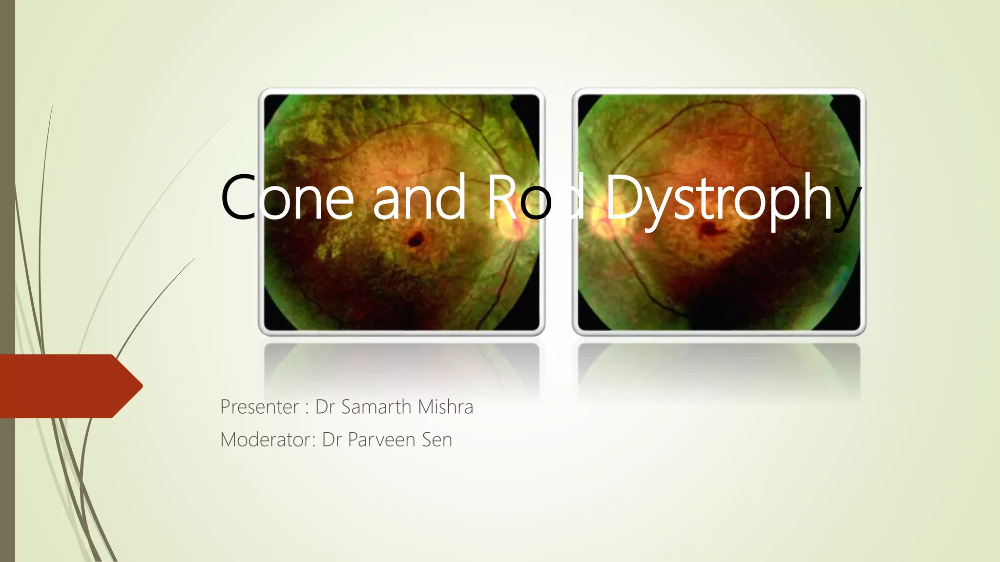 Cone and Rod Dystrophy | PPTX