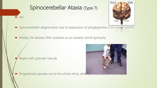 Cone and Rod Dystrophy | PPTX | Eye and Vision Conditions | Diseases ...