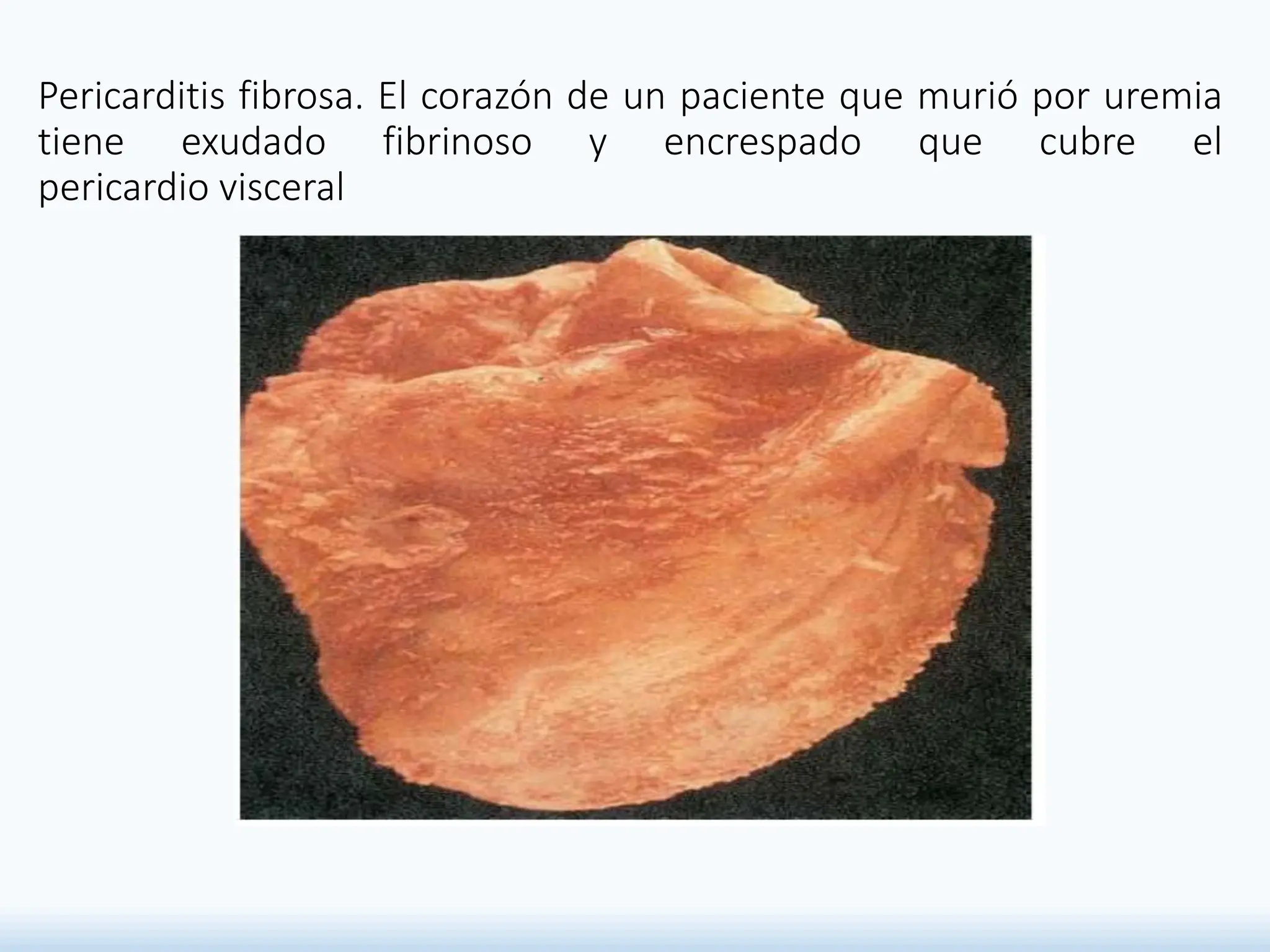 Conf 7 Pericardio.ppt Pericarditis. Tipos | PPT