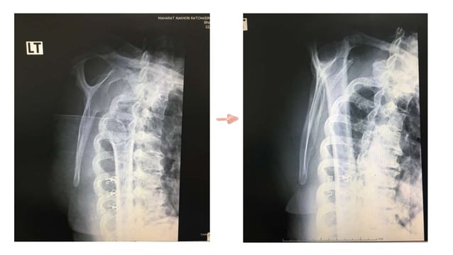 Conference ant shoulder dislocation | PPT