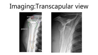 Conference ant shoulder dislocation | PPTX