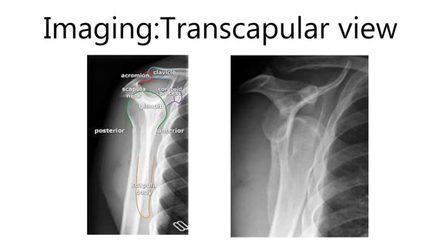 Conference ant shoulder dislocation | PPT