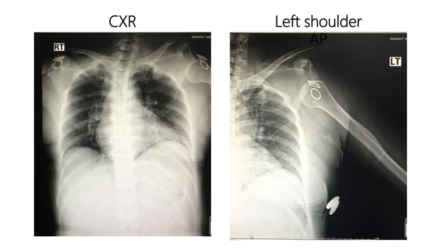 Conference ant shoulder dislocation | PPT