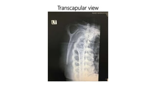 Conference ant shoulder dislocation | PPTX
