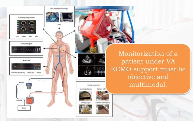 2022 Conference hemodynamic monitoring in VA ECMO | PPTX | Heart and ...