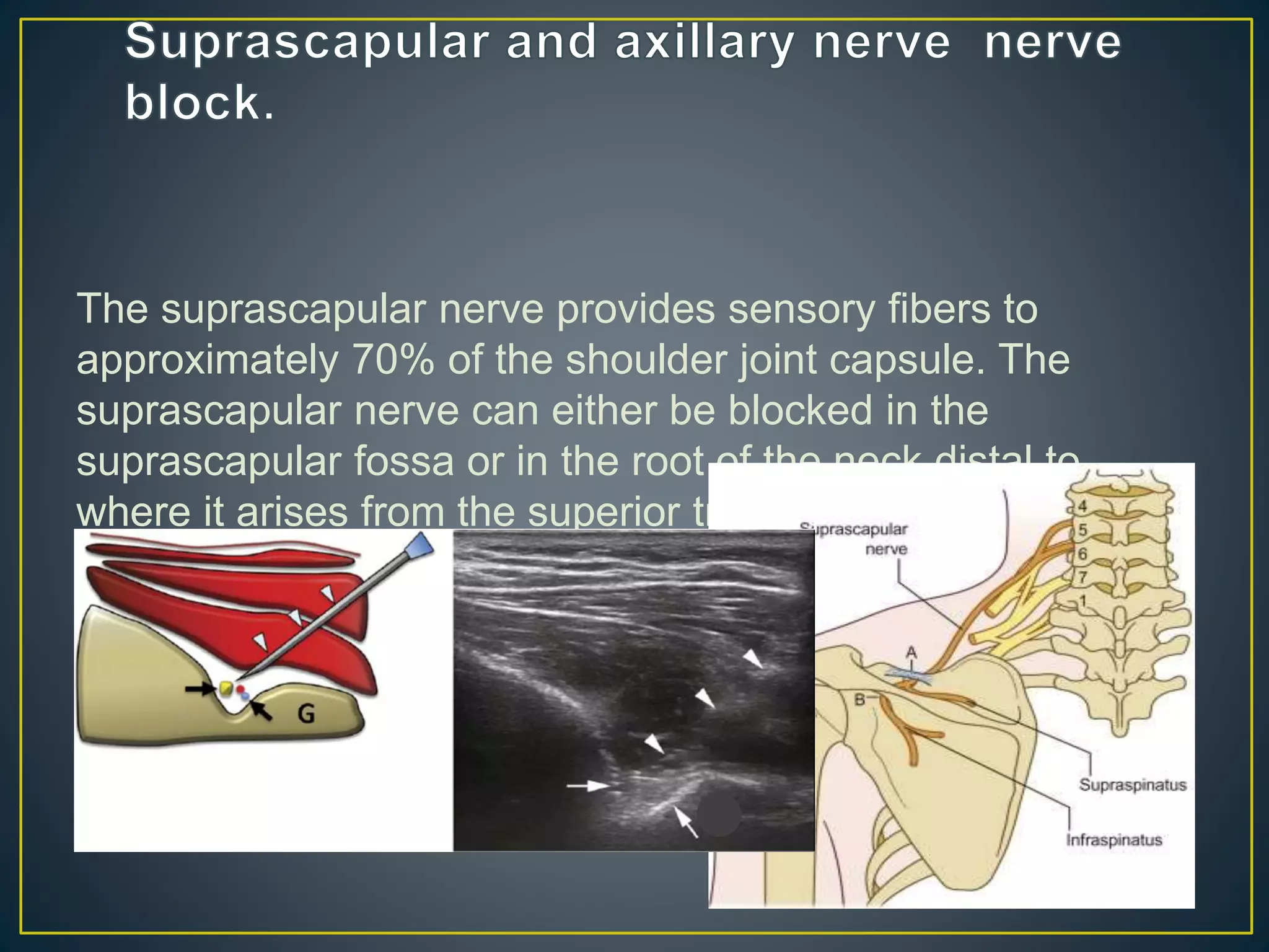regional anesthesia in shoulder arthroscopy | PPTX