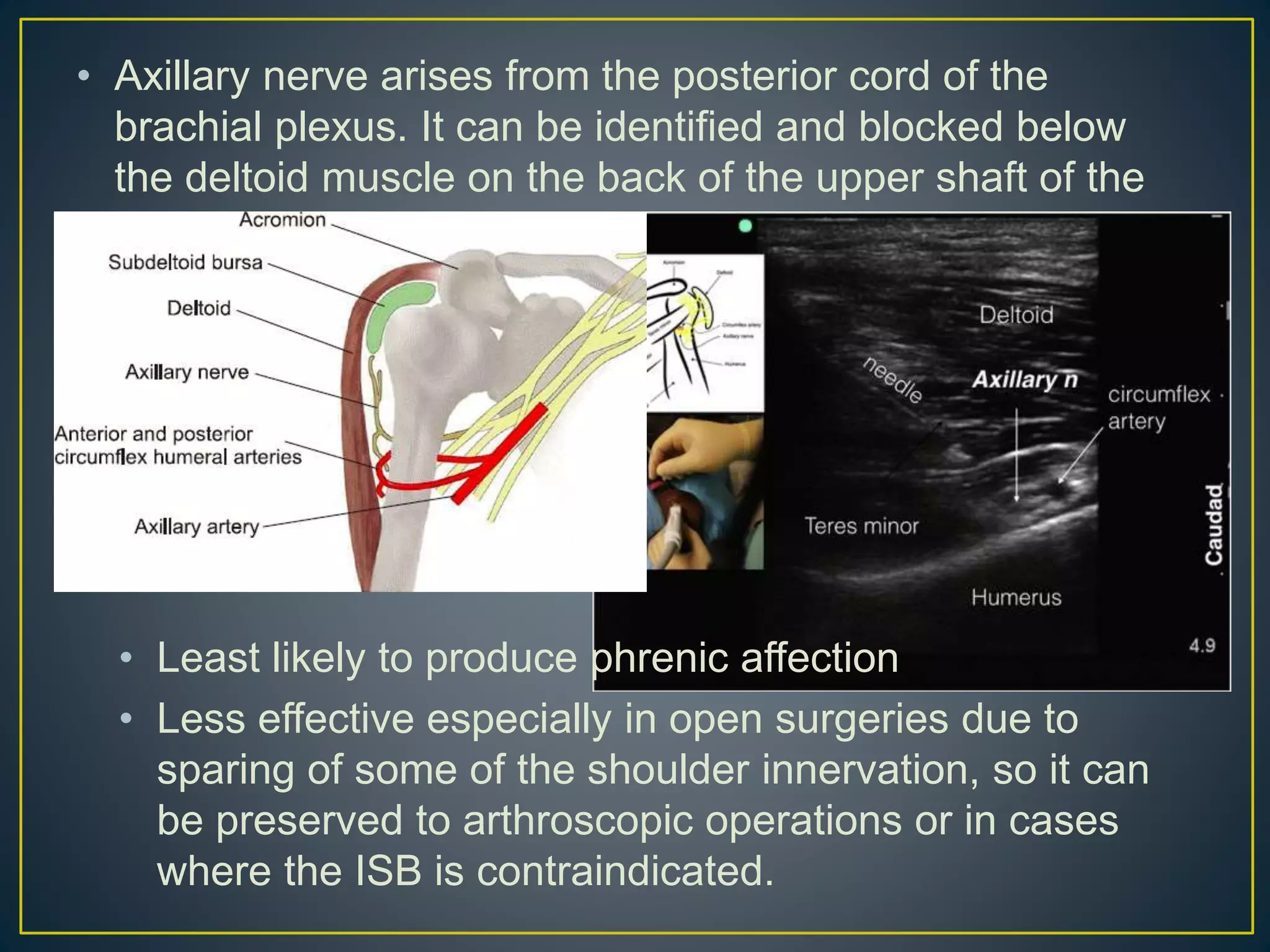 regional anesthesia in shoulder arthroscopy | PPTX