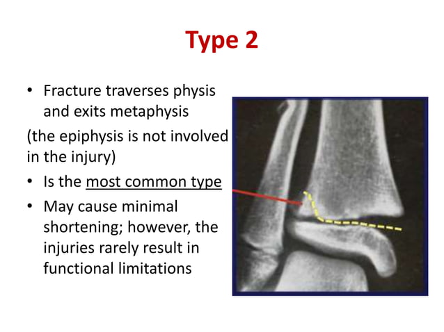 epiphyseal plate injury | PPT