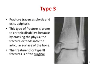 epiphyseal plate injury | PPTX | Death, Injury, or Military Conflict ...