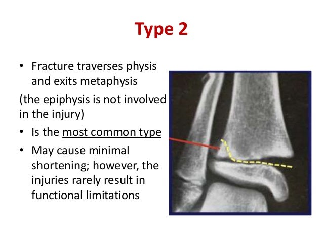 epiphyseal plate injury