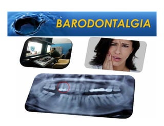 Barodontalgia, Reporte de Siete Casos en Vuelo Real y Simulado | PDF