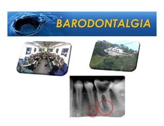 Barodontalgia, Reporte de Siete Casos en Vuelo Real y Simulado | PDF