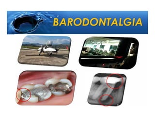 Barodontalgia, Reporte de Siete Casos en Vuelo Real y Simulado | PDF