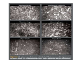 Confocal microscopy | PPTX | Eye and Vision Conditions | Diseases and ...