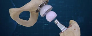 Customized 3D Hip Replacement Surgeries are Successful | PPT