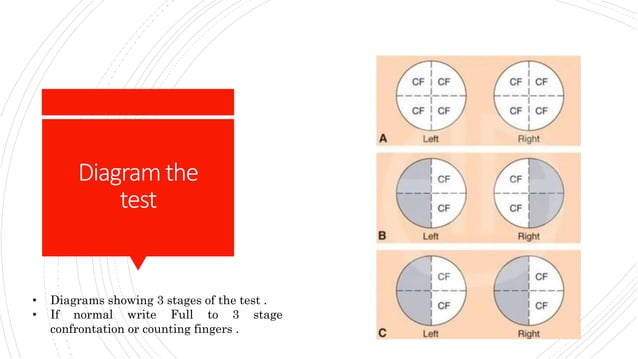 Confrontation test | PPTX | Eye and Vision Conditions | Diseases and ...