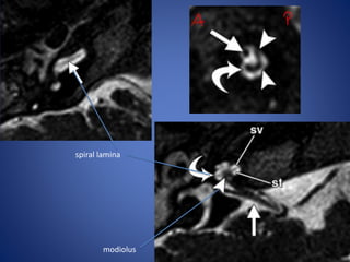 Congenital Sensoryneural hearing loss imaging | PPTX