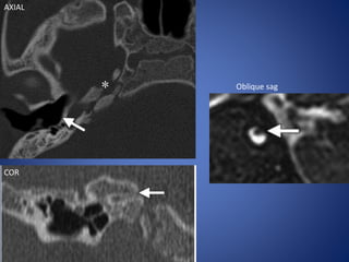 Congenital Sensoryneural hearing loss imaging | PPTX
