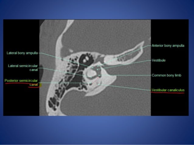 Congenital Sensoryneural hearing loss imaging