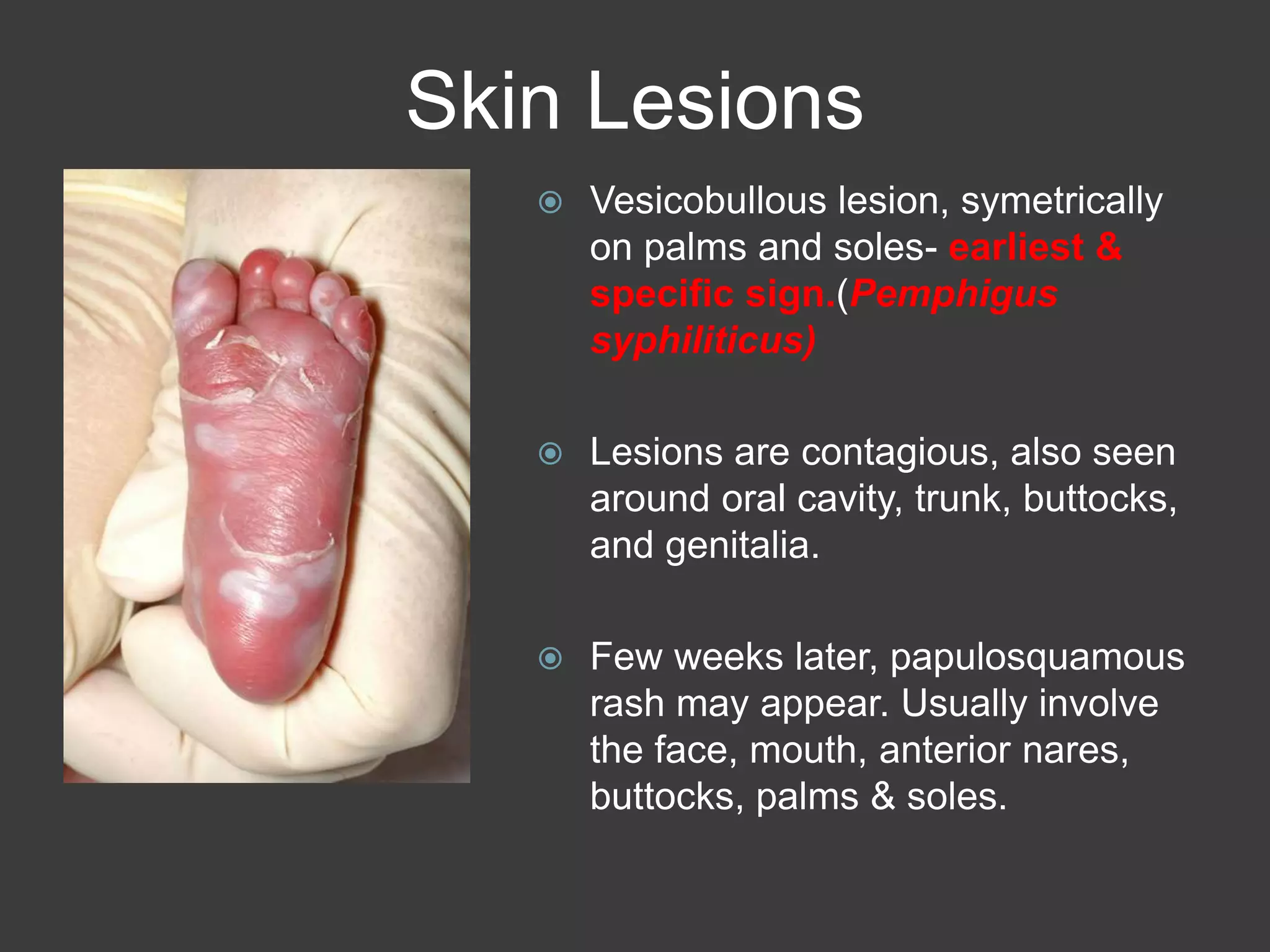 Cong. syphilis | PPTX