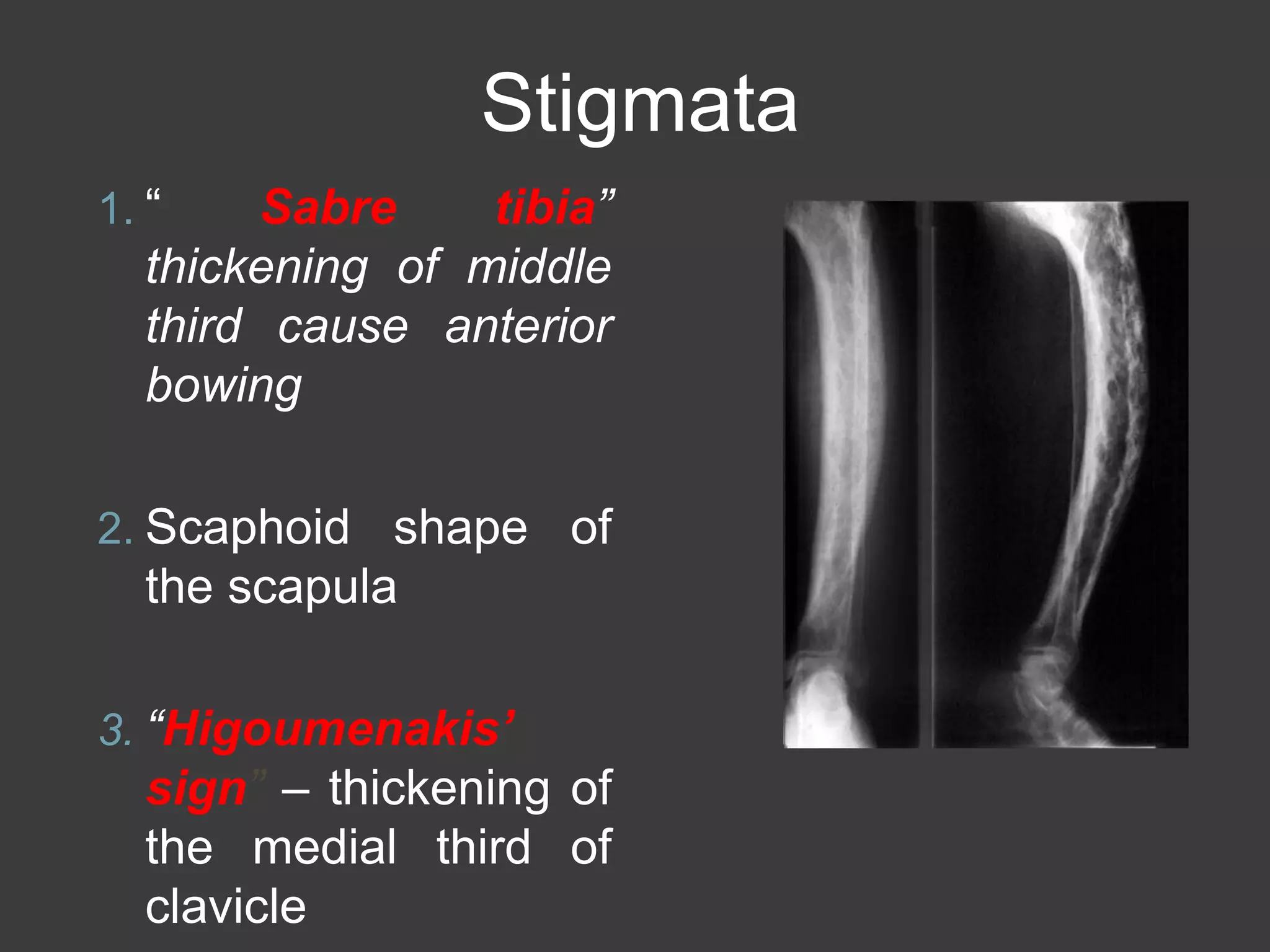 Cong. syphilis | PPTX