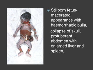 Cong. syphilis | PPT