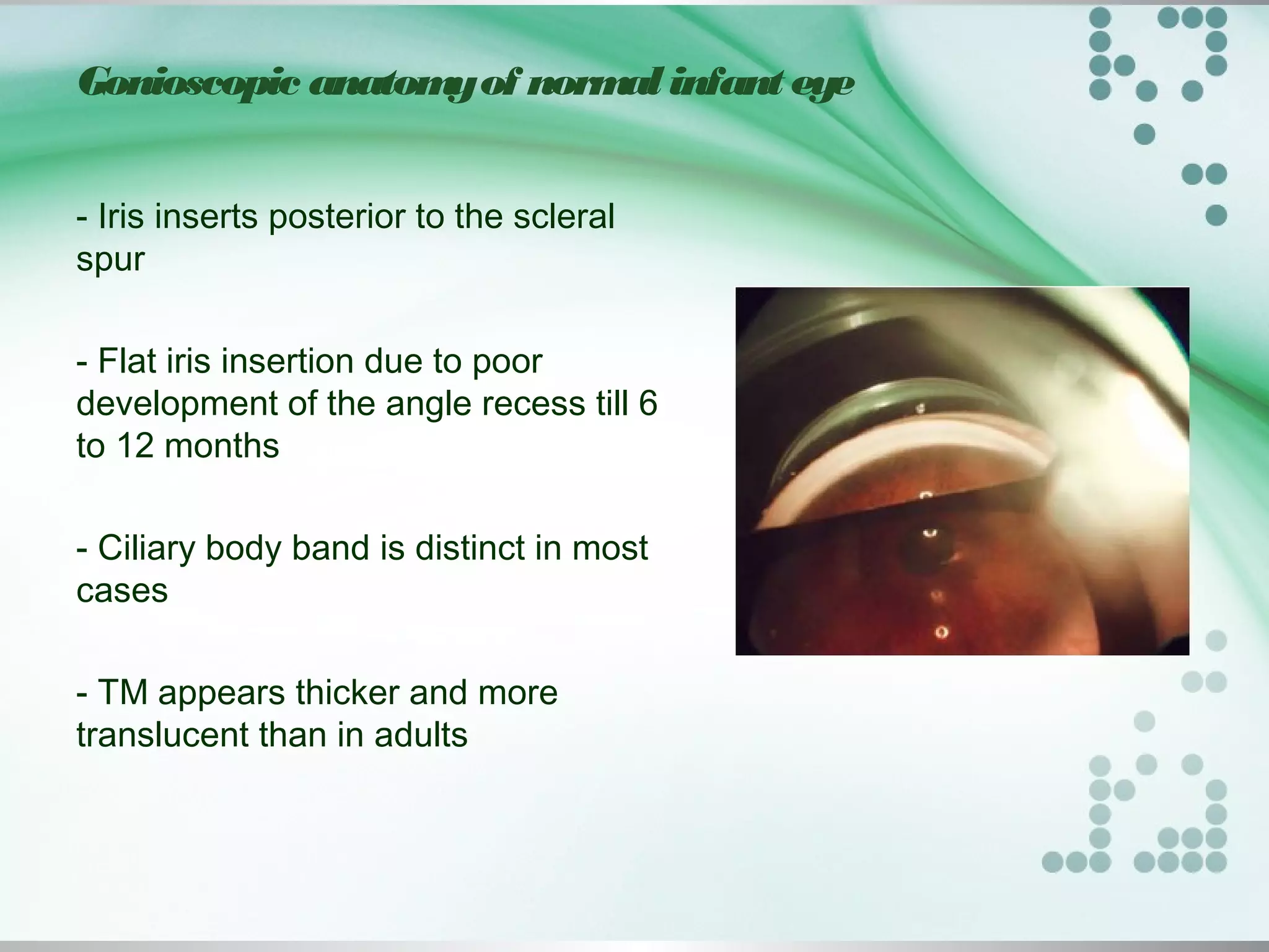 congenital glaucoma and congenital cataract | PPT
