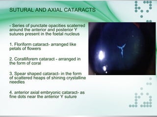 Anterior Axial Embryonic Cataract