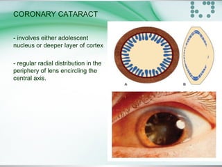 Coronary Cataract