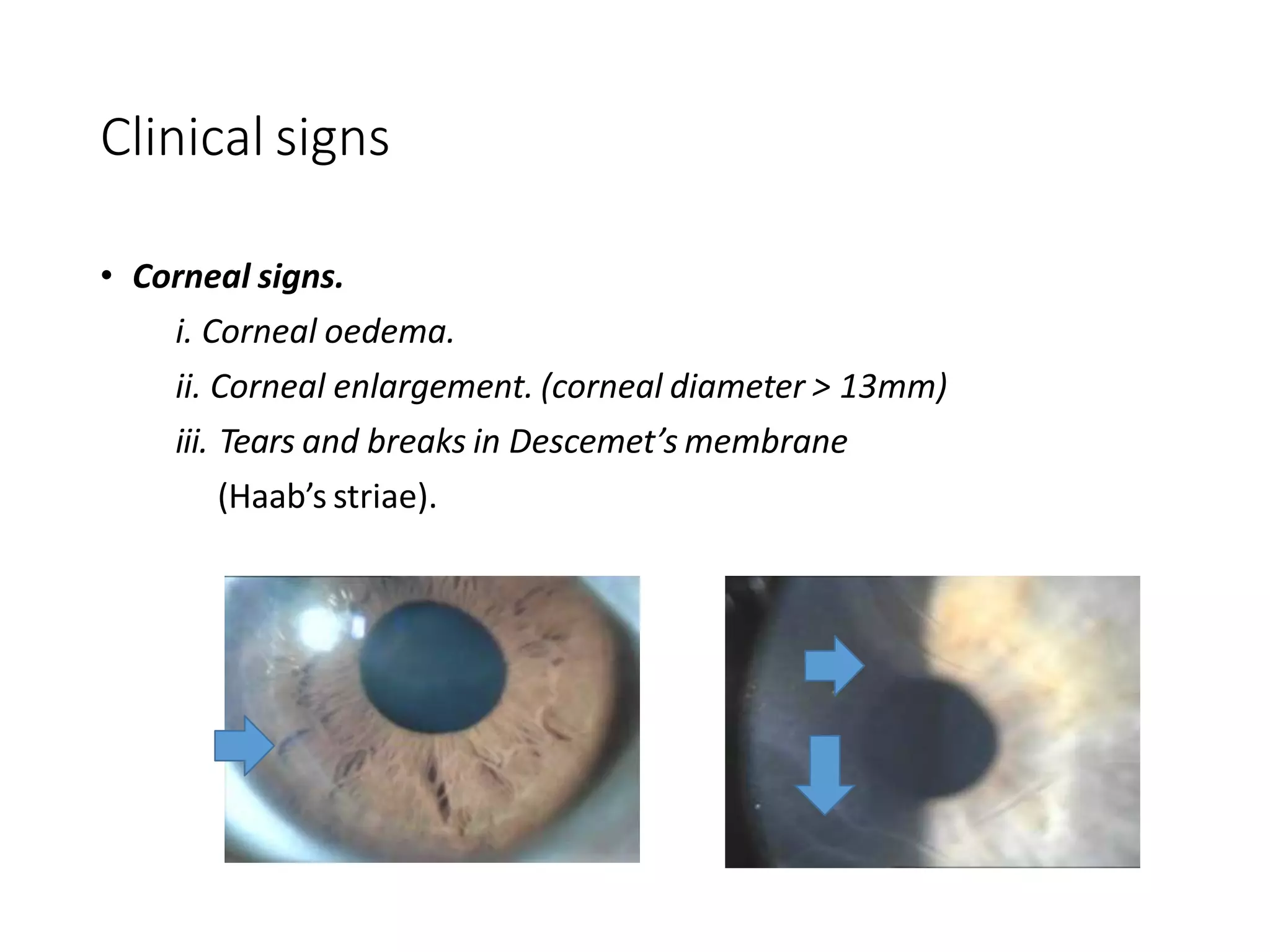 congeital_glaucoma.pptx