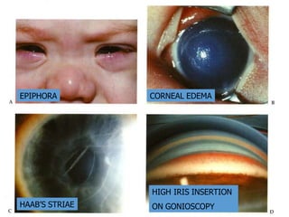 congeital_glaucoma.pptx