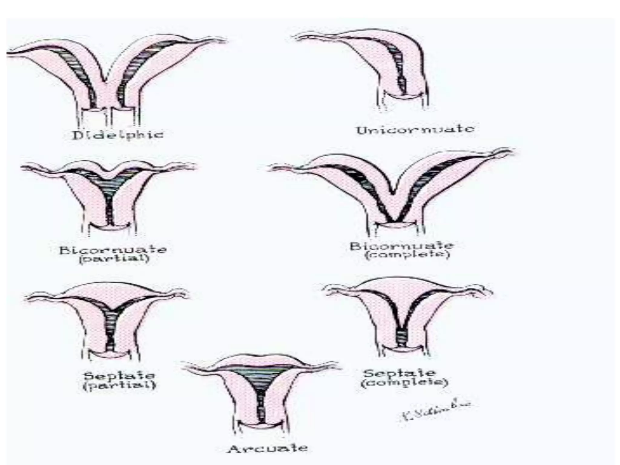 Congenital disorders of female reproductive tract | PPTX | Pregnancy ...