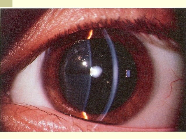 Congenital & infantile cataract | PPT