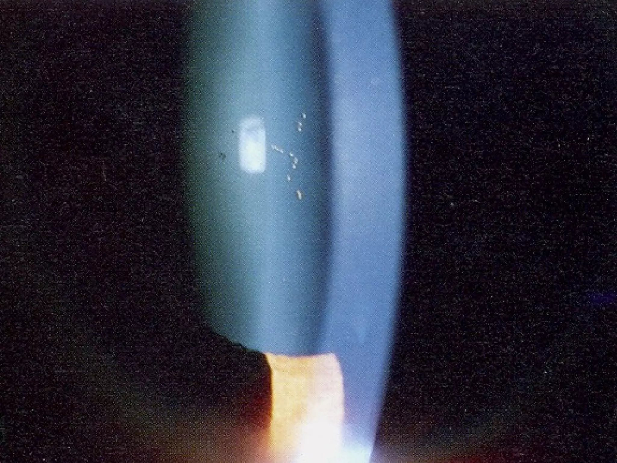 Congenital defects of the lens | PPT