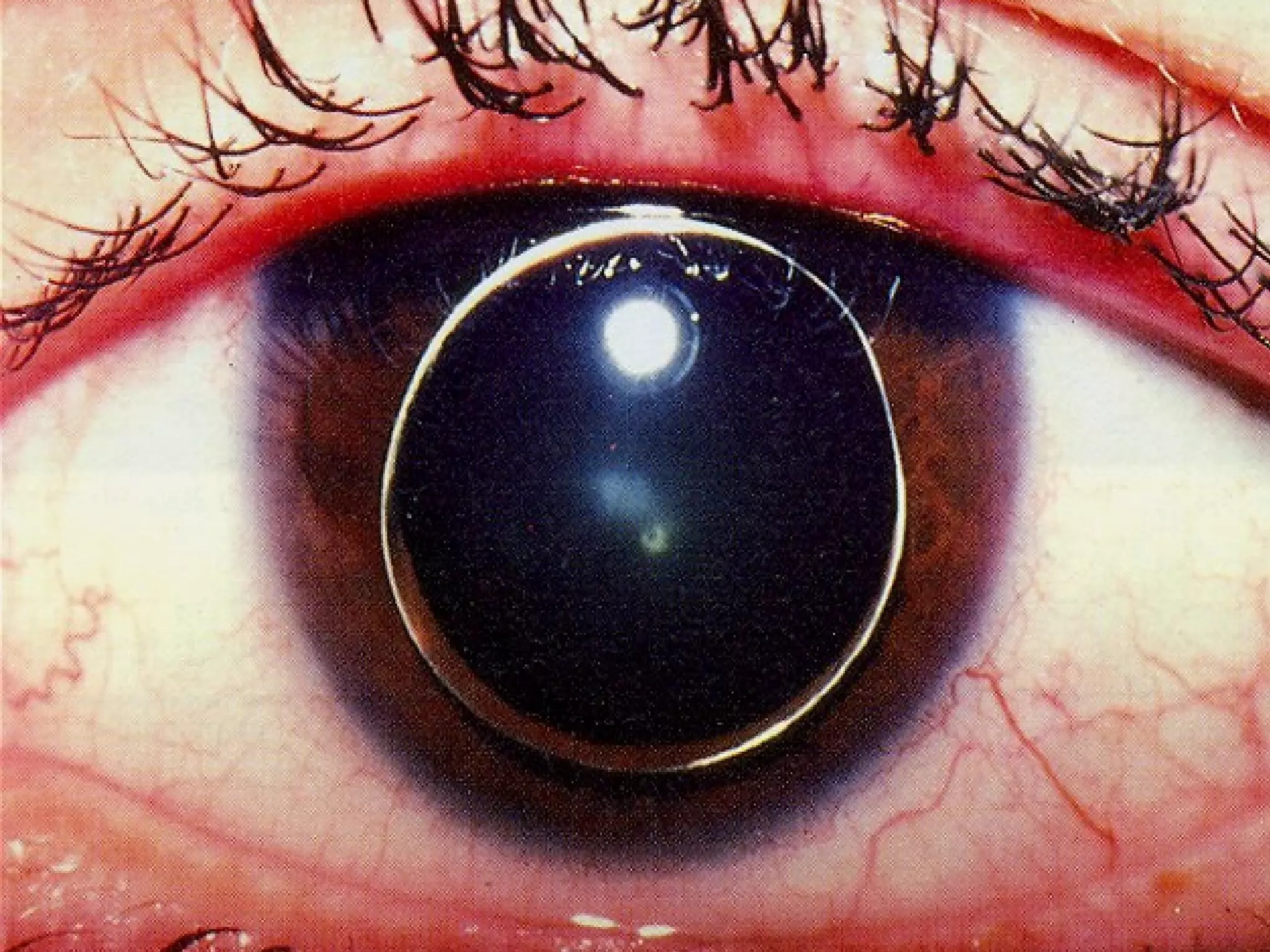 Congenital defects of the lens | PPT